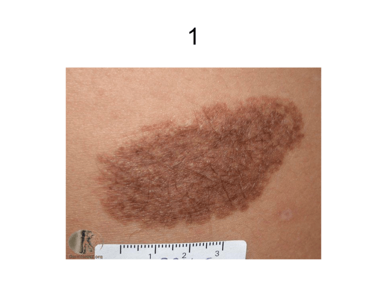 Pigmented Skin Lesions Pigmented Skin Lesions