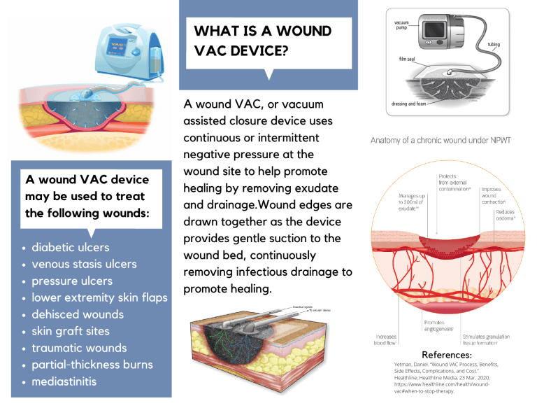 Wound VAC Device Uses Benefits And Discontinuation Wound VAC Device Uses Benefits And Discontinuation