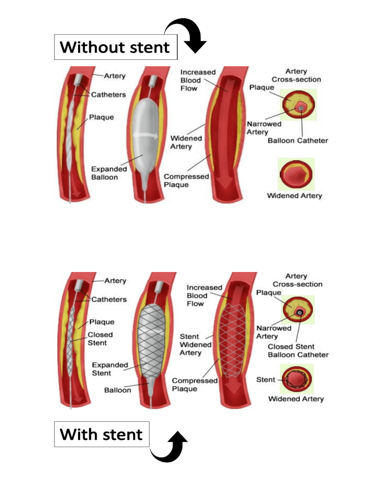Angioplasty: Procedure, Stents, and Advancements