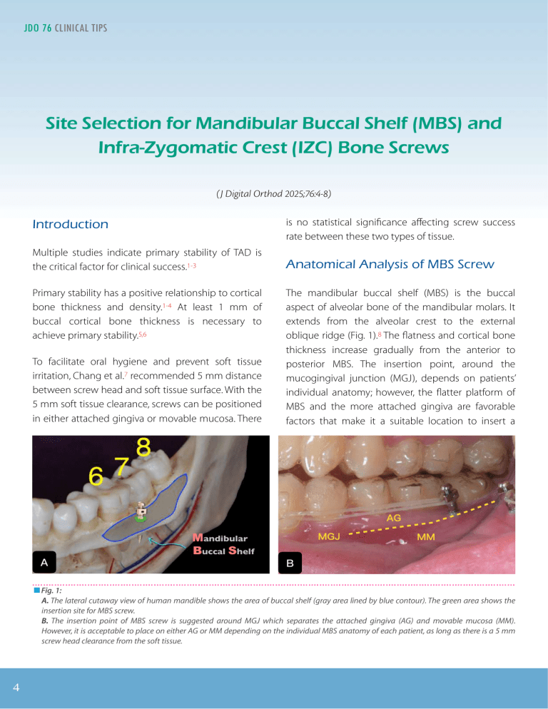 MBS & IZC Bone Screw Site Selection: Clinical Orthodontic Tips