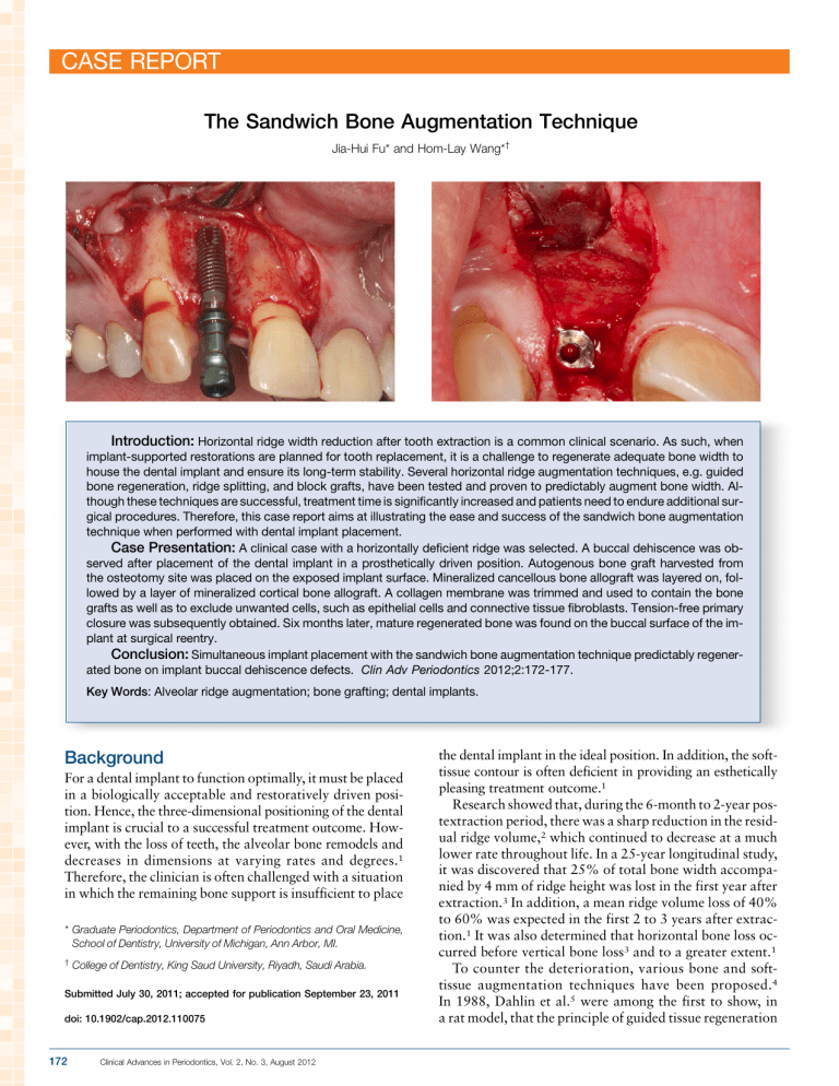 Sandwich Bone Augmentation Technique: A Case Report