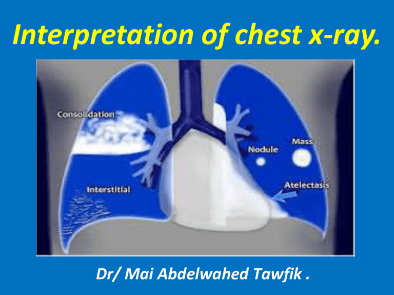 Chest X-ray Interpretation: A Comprehensive Guide to Lung Abnormalities
