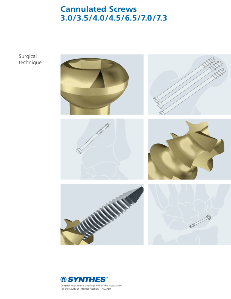 Cannulated Screw Surgical Technique Guide