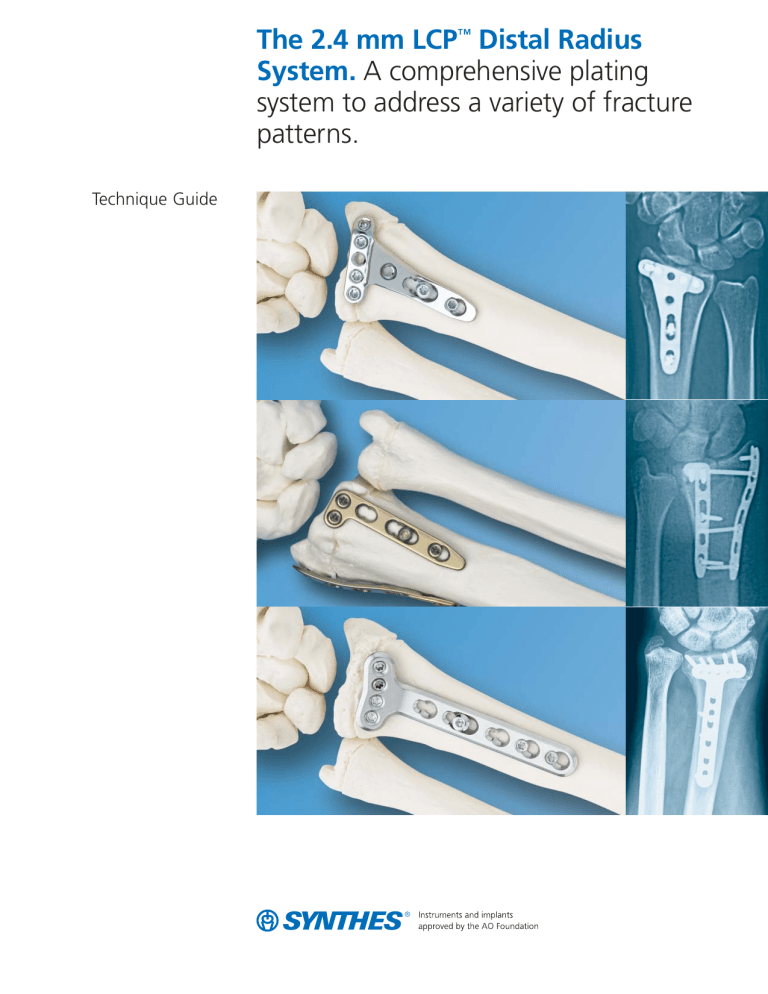 2.4 mm LCP Distal Radius System Technique Guide